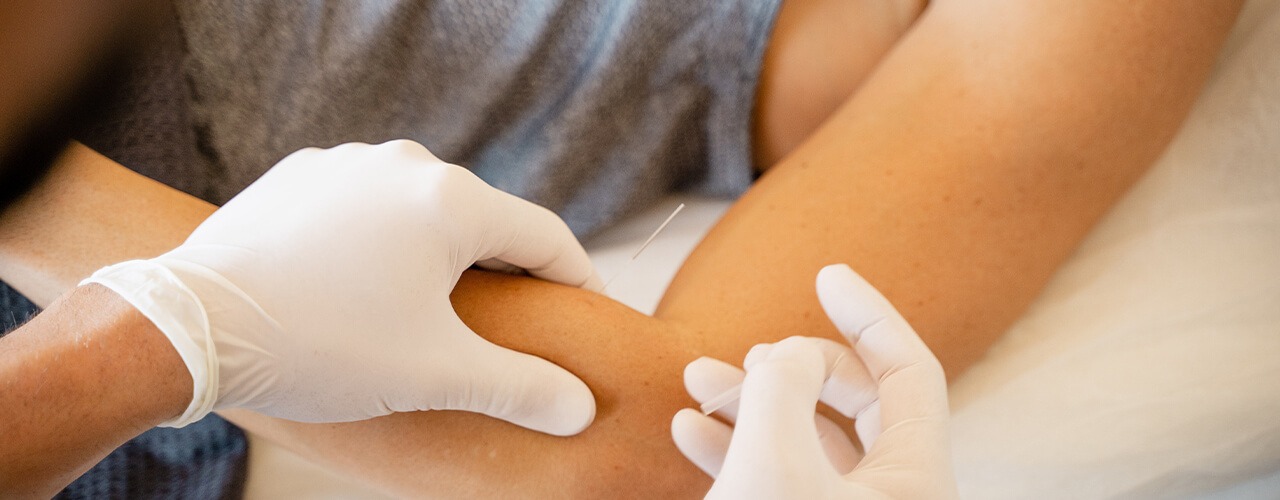 Benefits of Dry Needling - 6 Health Benefits of Dry Needling for Pain ...